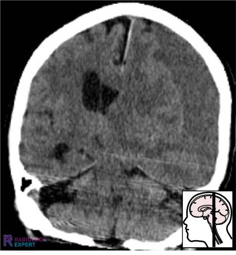 CT hersenen bloeding