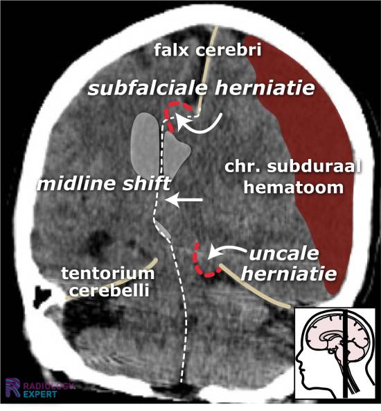 CT hersenen bloeding