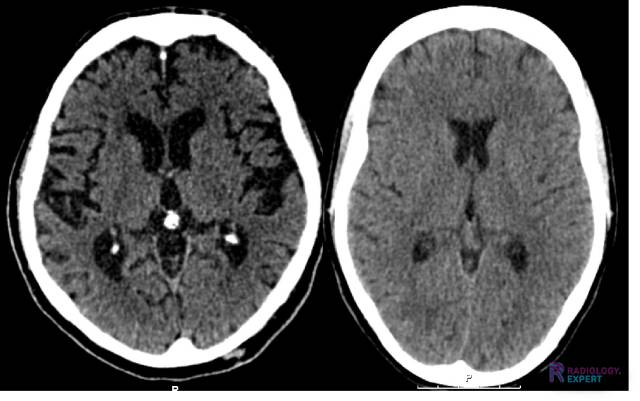 CT hersenen bloeding