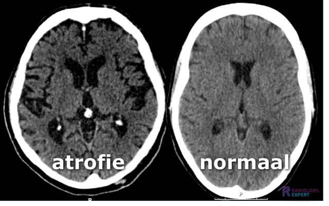 CT hersenen bloeding
