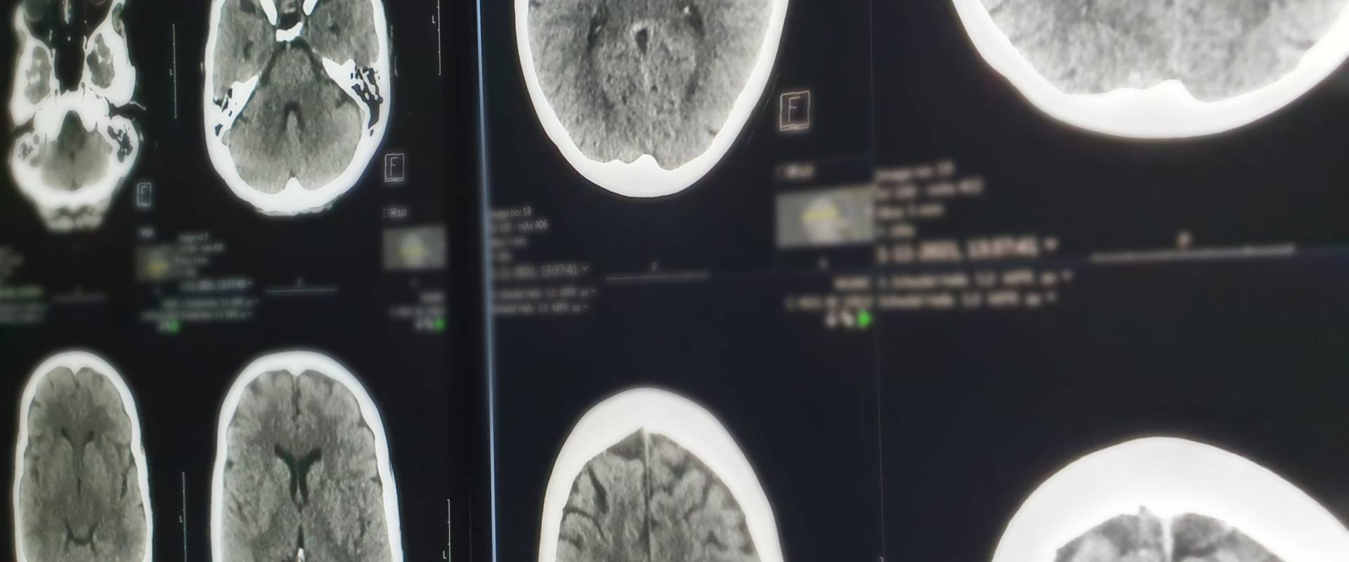 CT hersenen bloeding