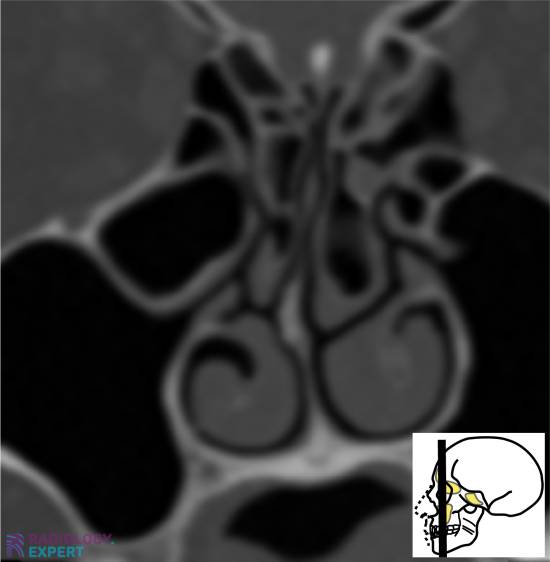 CT sinus