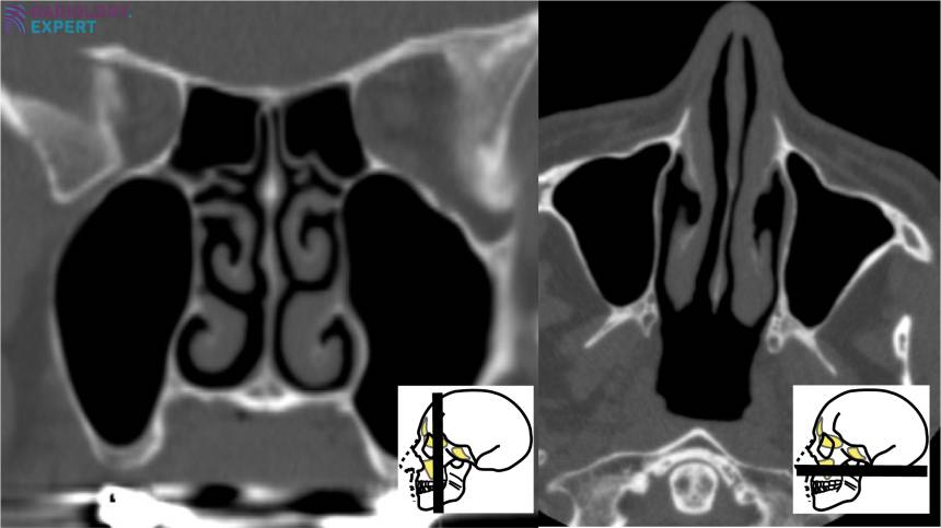 CT sinus