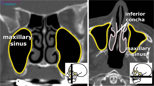 Ct Sinus