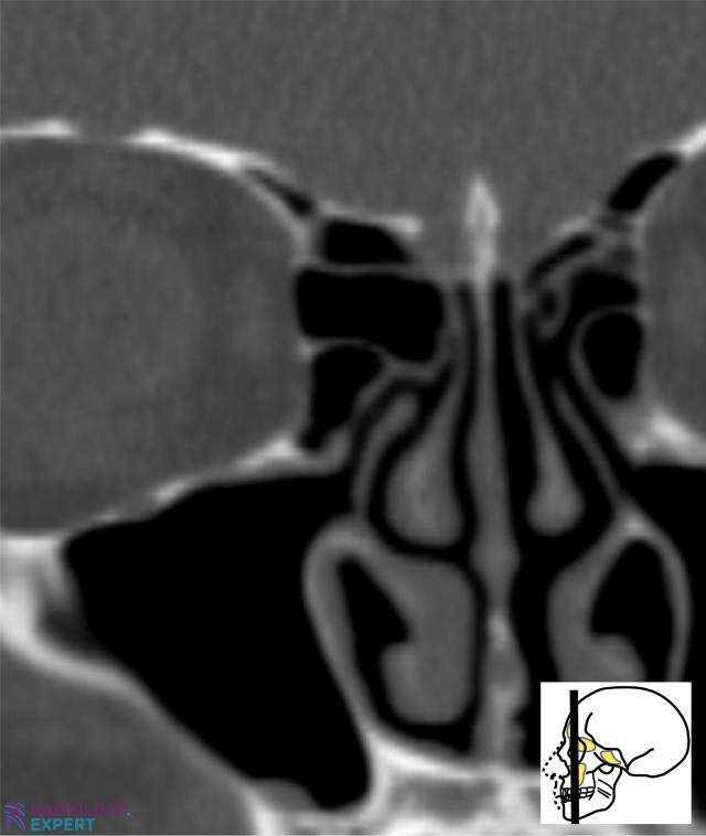 CT sinus