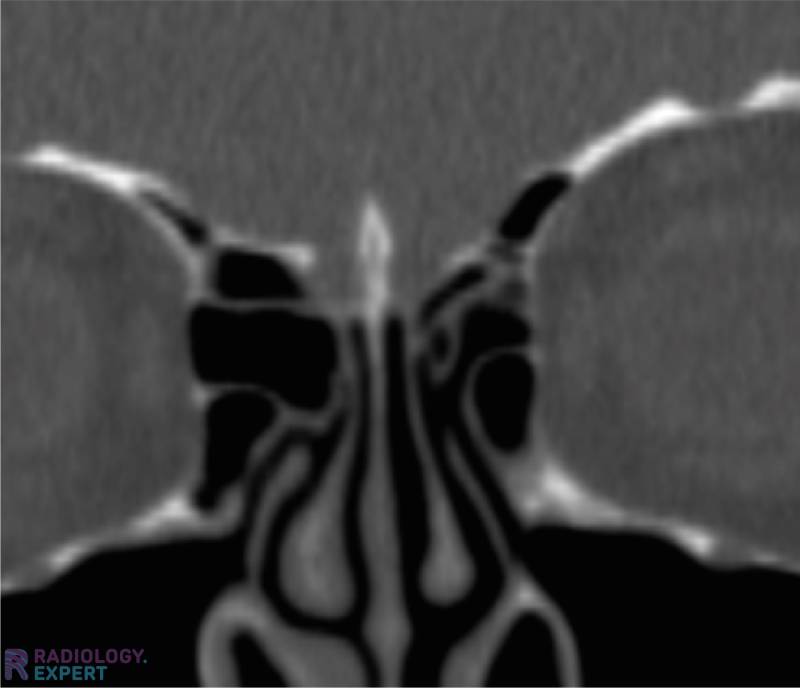 CT sinus