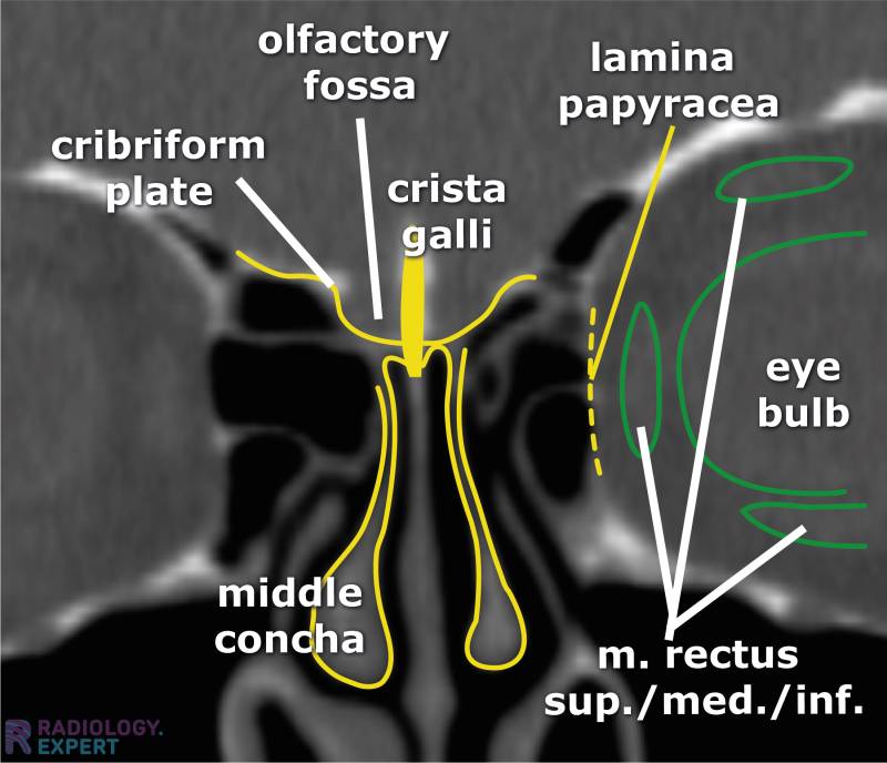 CT sinus