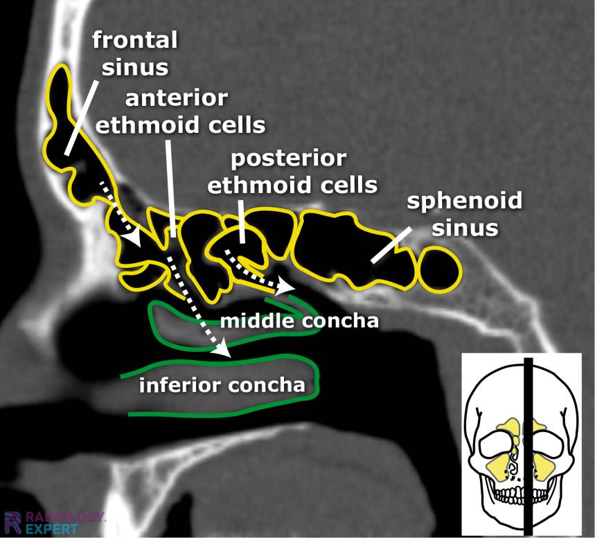 CT sinus