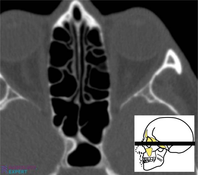 CT sinus