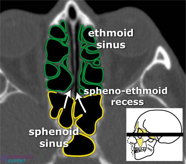 Ct Sinus