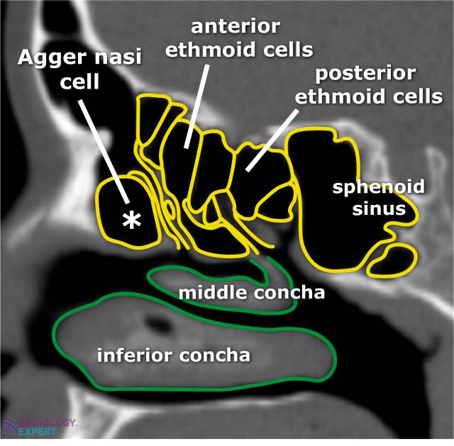 CT sinus