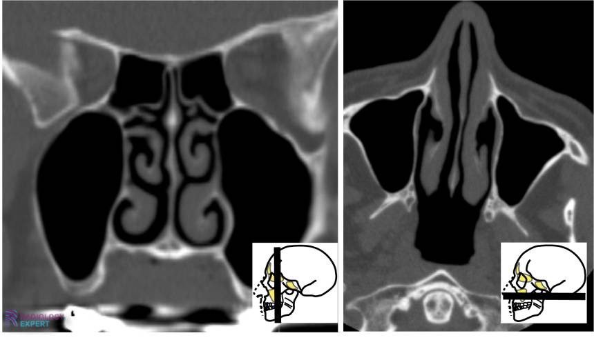 CT sinus