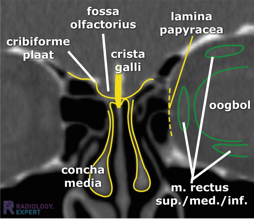 CT sinus