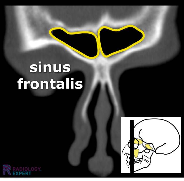 CT sinus
