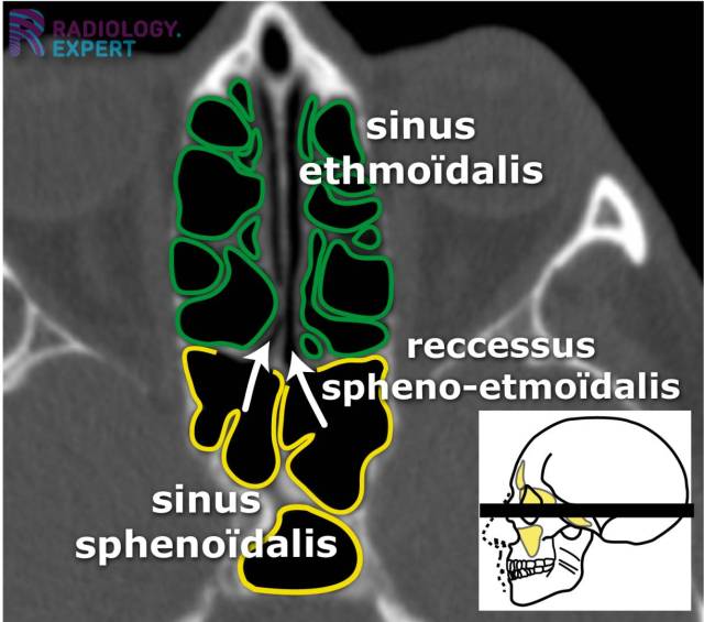 CT sinus