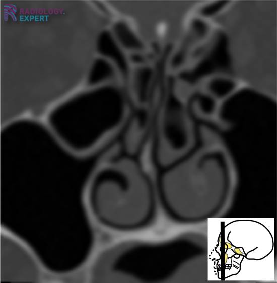 CT sinus