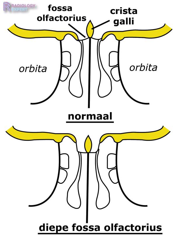CT sinus