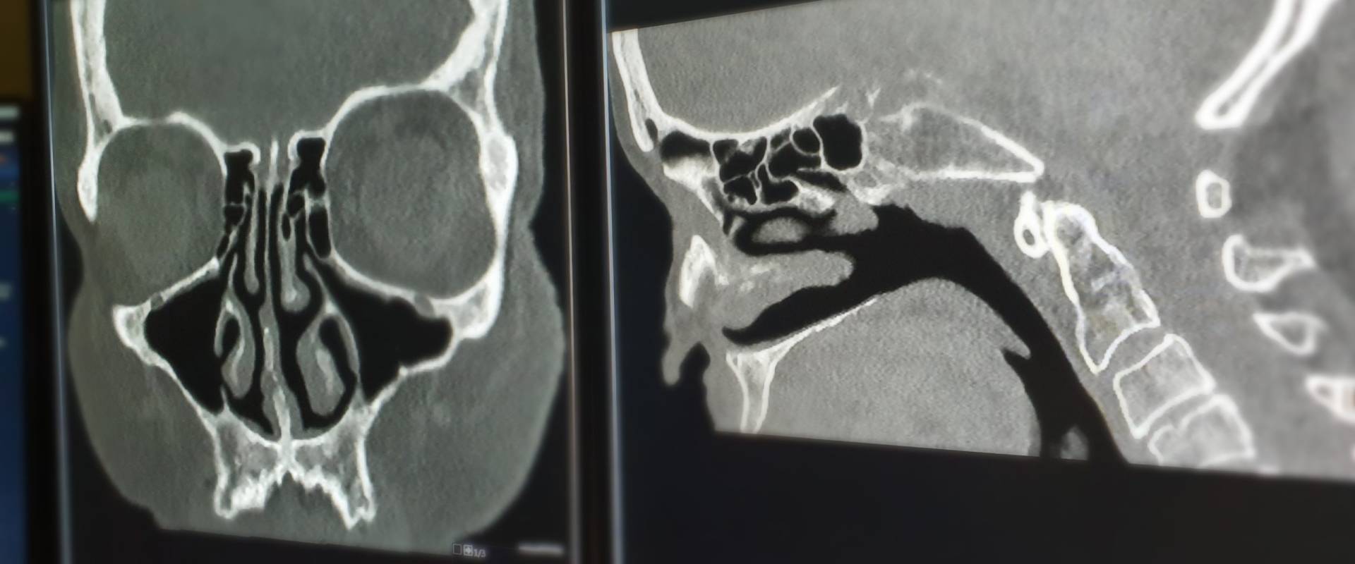 CT sinus