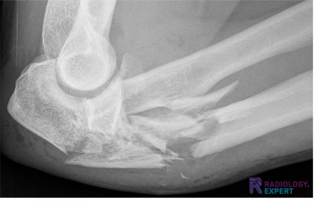 Fracture general principles