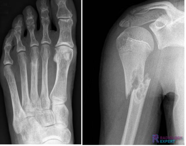 Pathologic Fracture X Ray Pathologic Fracture: What It Is, Causes