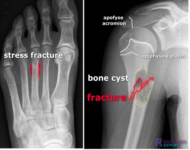 Ulna Hairline Fracture The Radius And Ulna | Radiology Key