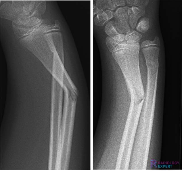 Fracture general principles