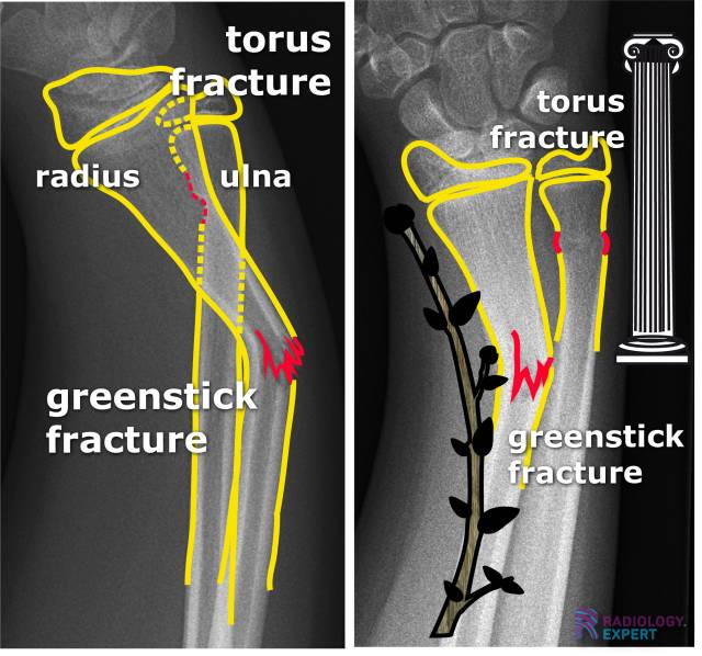 Fracture general principles