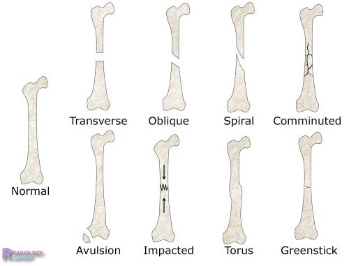 Fracture general principles