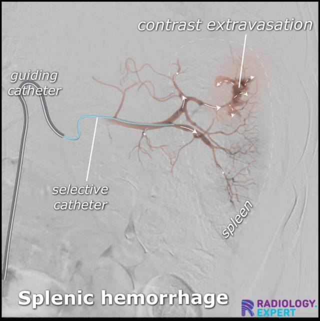 Interventional Radiology - General