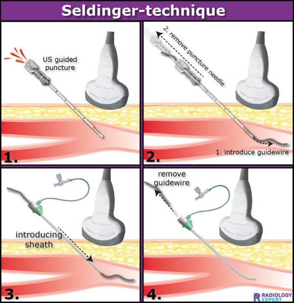 Interventional Radiology - General