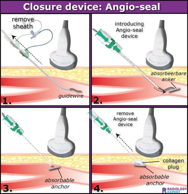 Interventional Radiology - General