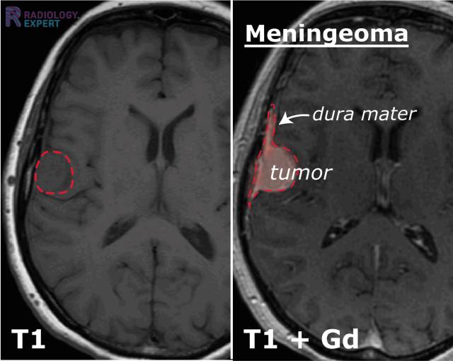 MRI Technique