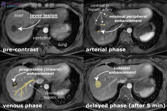 MRI Technique