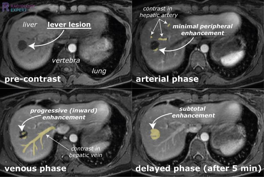 MRI Technique