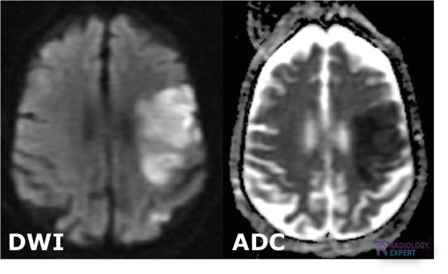 MRI Technique