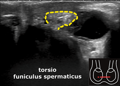 Scrotal ultrasound