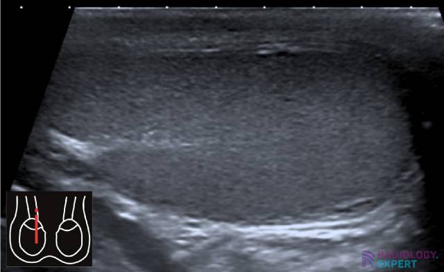 Scrotal ultrasound