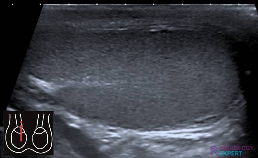 Scrotal ultrasound