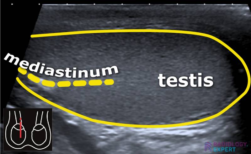 Scrotal Ultrasound