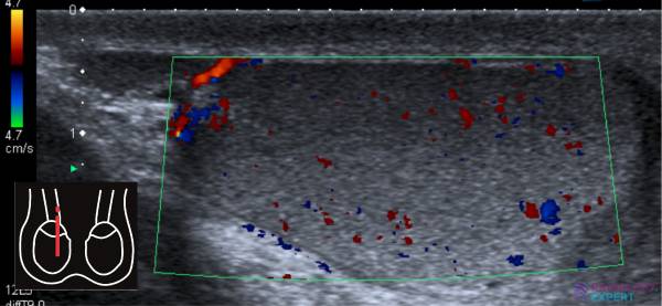 Scrotal ultrasound