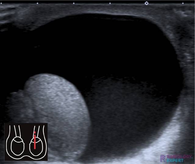Scrotal Ultrasound
