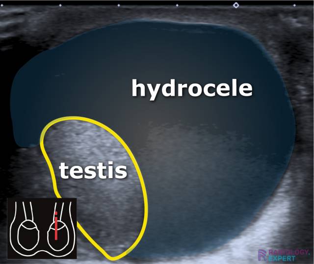 Scrotal Ultrasound