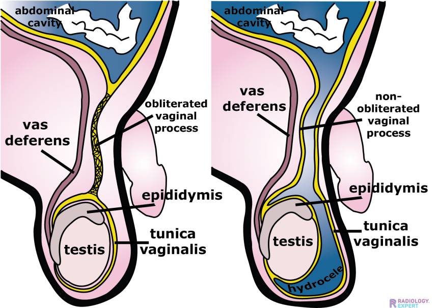 Scrotal Ultrasound