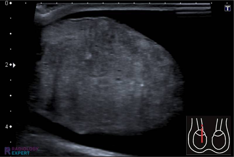 Scrotal ultrasound