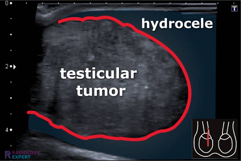 Scrotal ultrasound