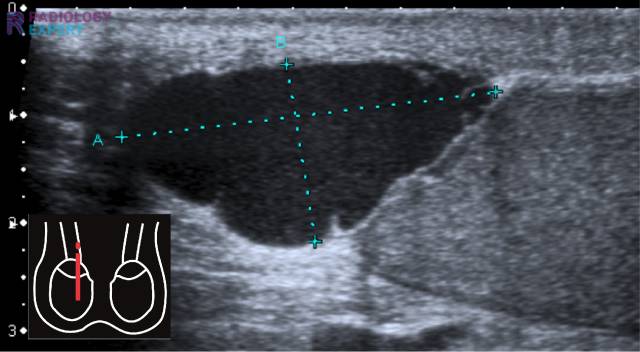 Scrotal ultrasound