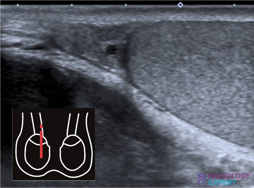 Scrotal ultrasound