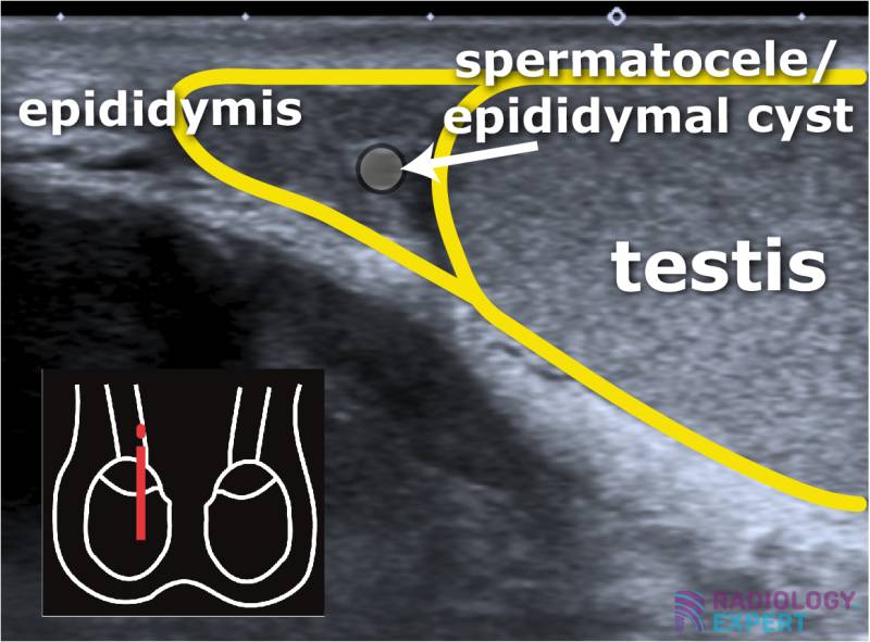 Scrotal ultrasound