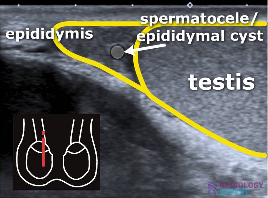 Scrotal ultrasound