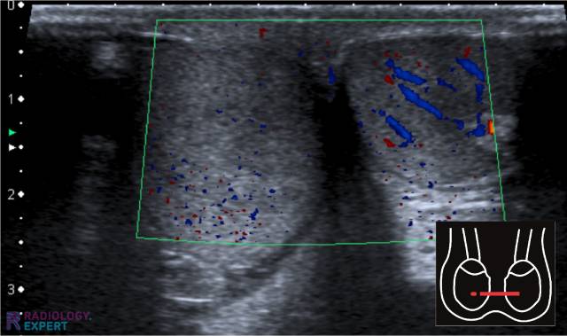 Testicular Torsion Ultrasound